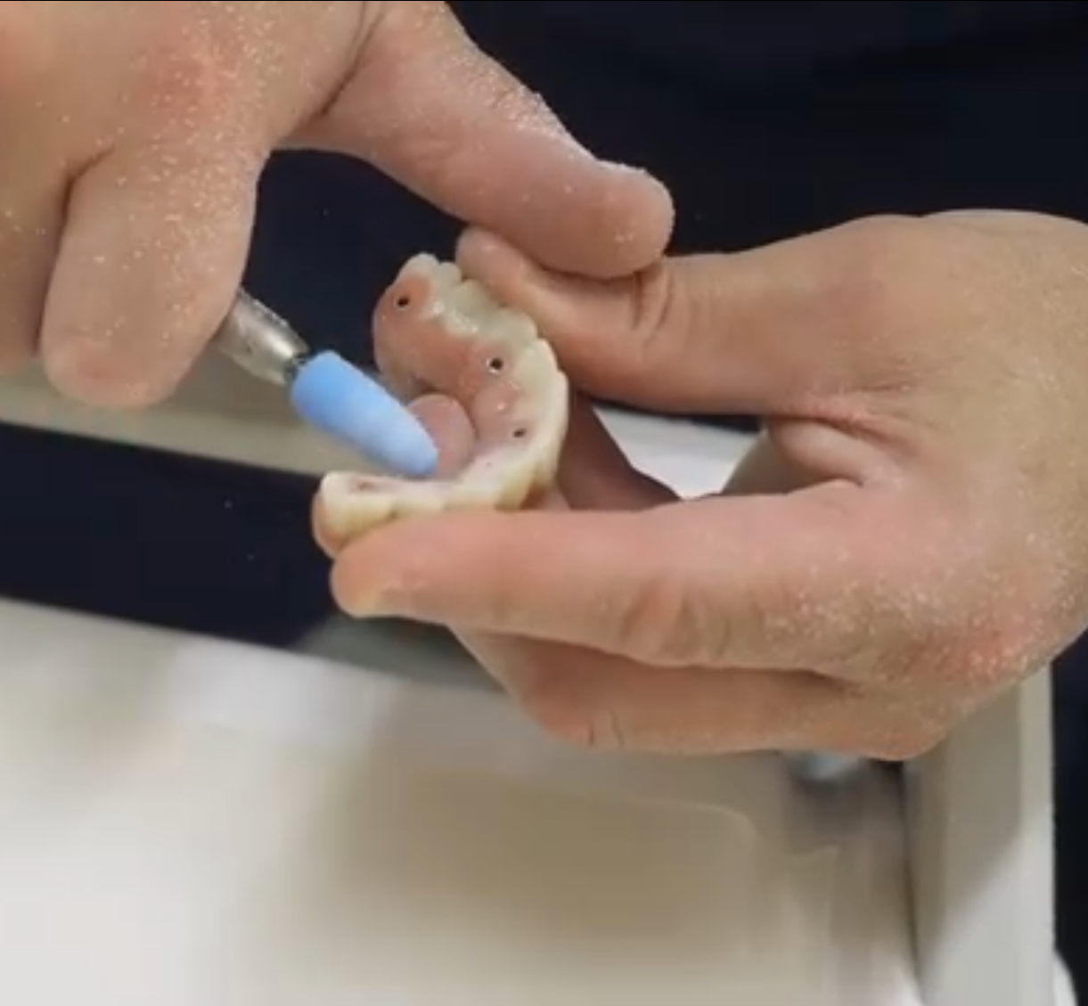 Provisional Bridge Conversion for CHROME GuidedSMILE – Quoris3D