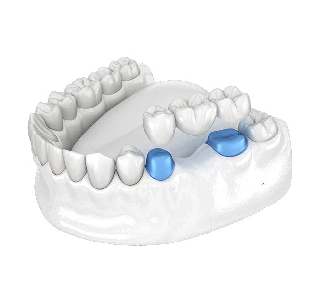Implant Crown & Bridge – Quoris3D