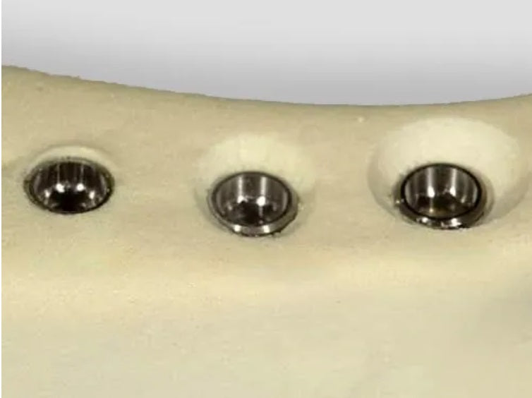 Universal Shapers Guided Surgical Kit – Quoris3D